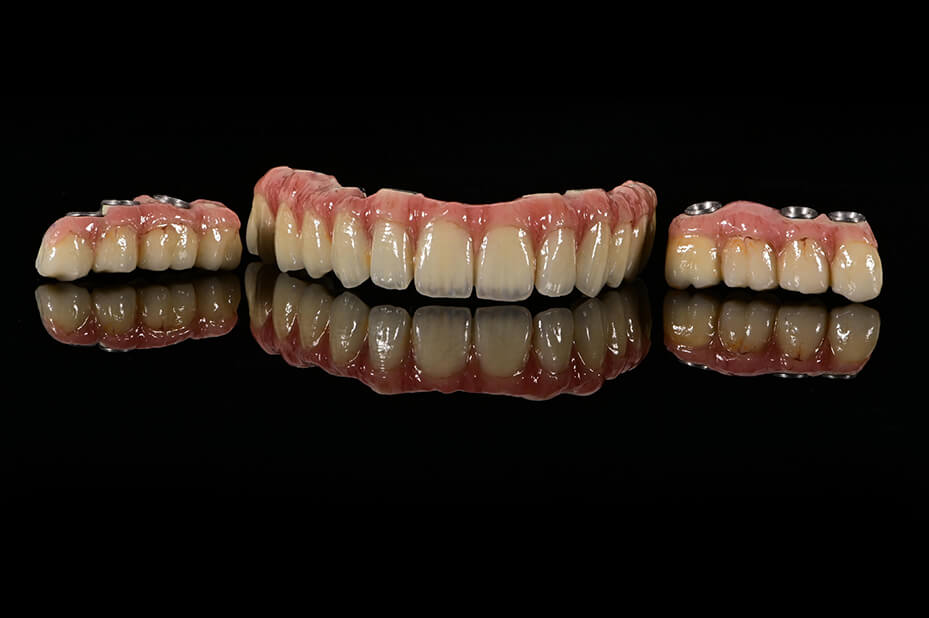 Dental Implants - Perfect Smile Dental Clinic
